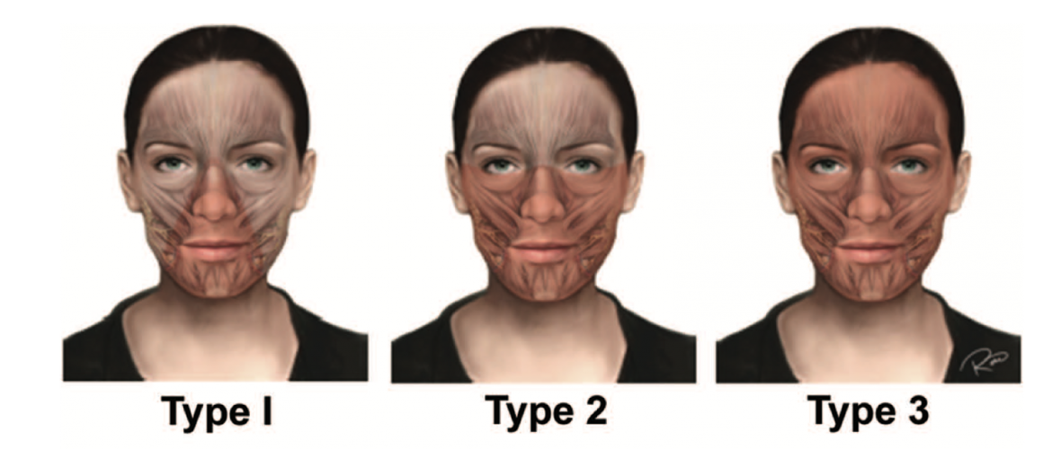 Classification of Defects - Face Transplants Dallas Fort Worth, Texas